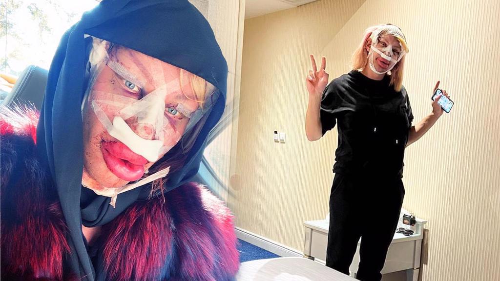 Honza Šimša o plastice obličeje: Mám nádherný nosík, chci ještě operaci ...