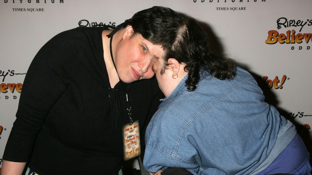 Zemřela nejstarší siamská dvojčata: Lori a George Schappell žili ...